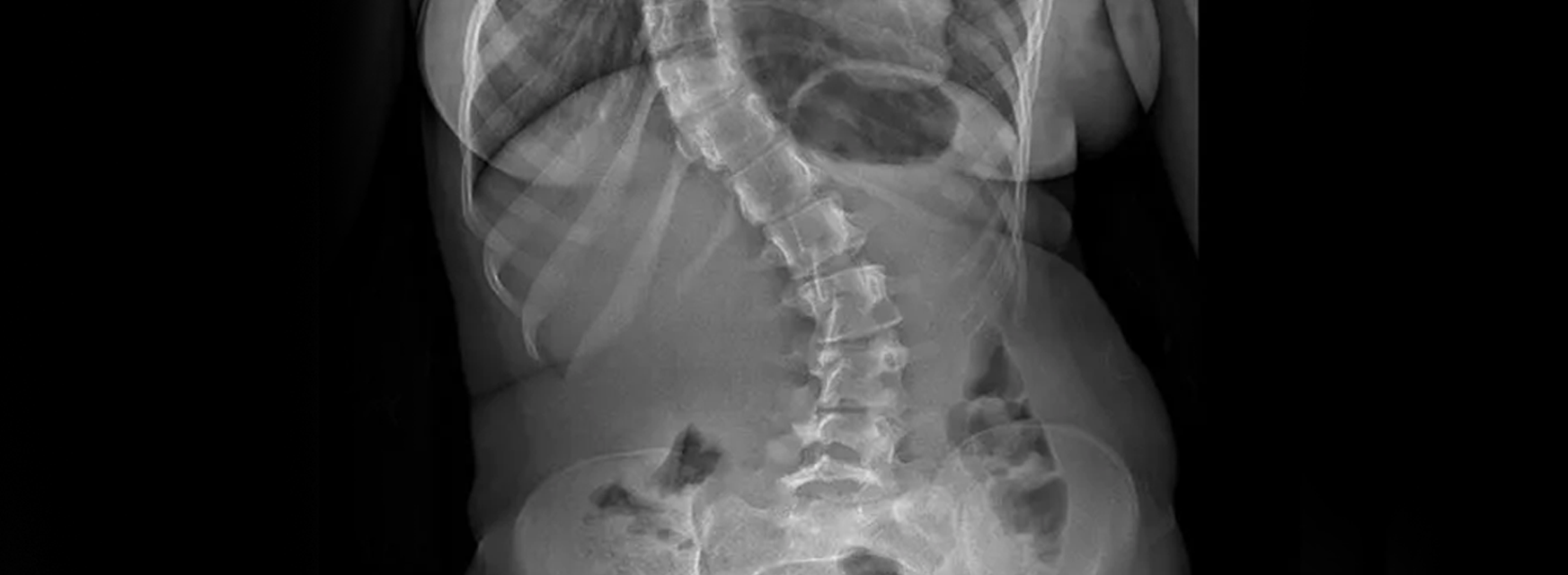 Conheça as principais doenças da coluna vertebral, como hérnia de disco ...
